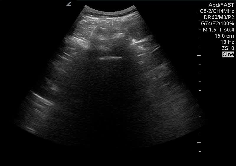 Difficult Lumbar Puncture? Ultrasound to the rescue! – ZuckerEM @ Northwell